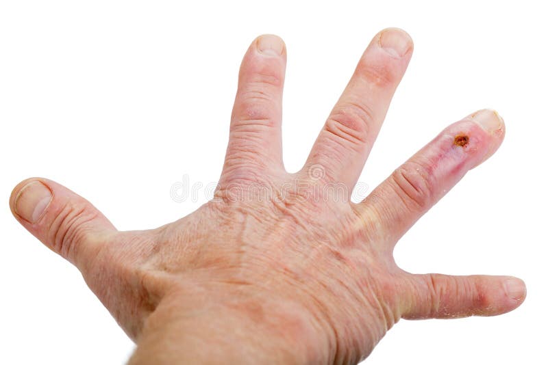 Postoperative Scar on the Fourth Finger Stock Photo - Image of entry ...
