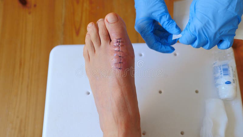 Postoperative Sutures on the Foot Stock Photo - Image of health ...