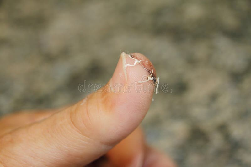 Une Blessure Profonde Sur Le Doigt Photo stock - Image du macro, main ...