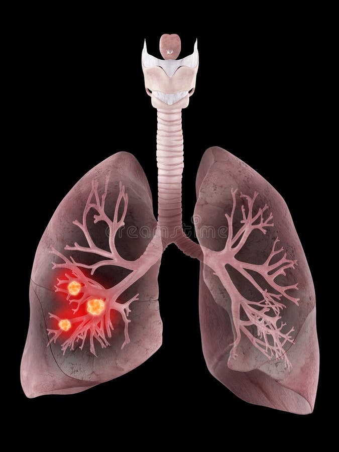 Le poumon et les bronches illustration stock. Illustration du airways ...
