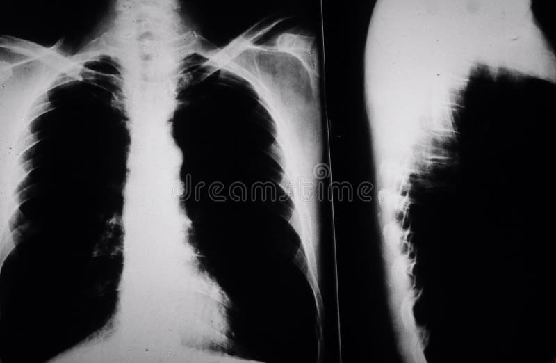 Poumons de fumeurs image stock. Image du maladie, radiologie - 1502535