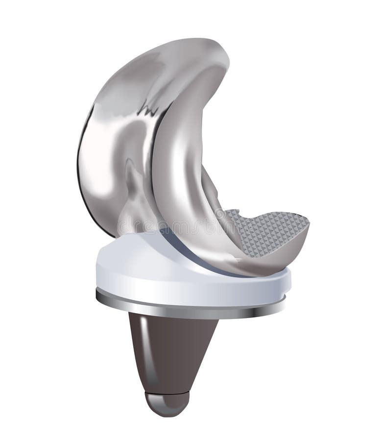 Prótesis de la rodilla stock de ilustración. Ilustración de salud ...