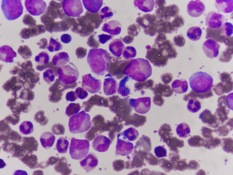 A Precursor Cell, Also Called a Blast Cell or Simply Blast, is a Stock ...