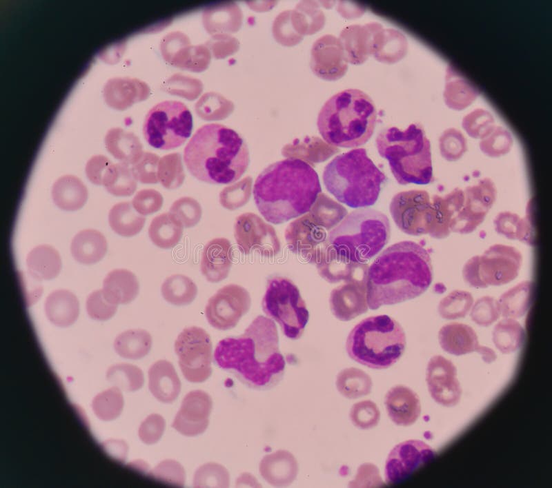 A Precursor Cell, Also Called a Blast Cell or Simply Blast, is a Stock ...