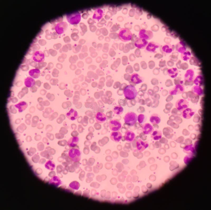 A Precursor Cell, Also Called A Blast Cell Or Simply Blast, Is A Stock ...