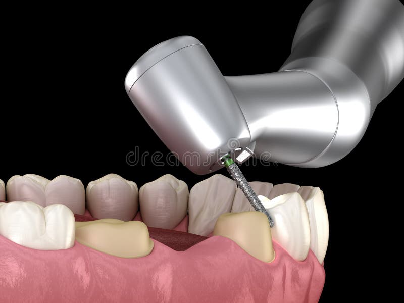 Premolar Preparation Process for Dental Crown Placement. Medically ...