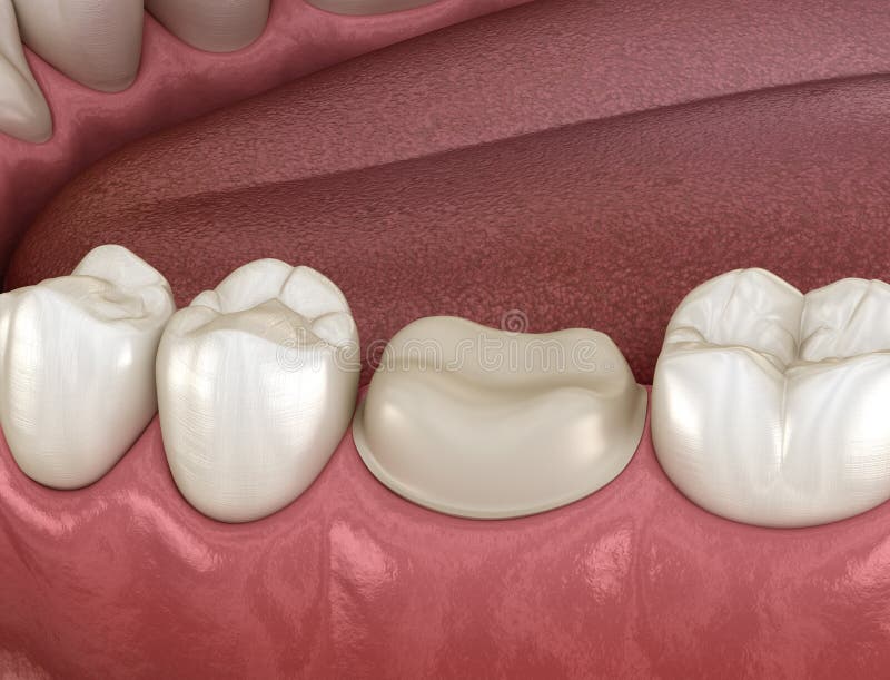 Preparated Molar Tooth for Dental Crown Placement. Medically Accurate ...
