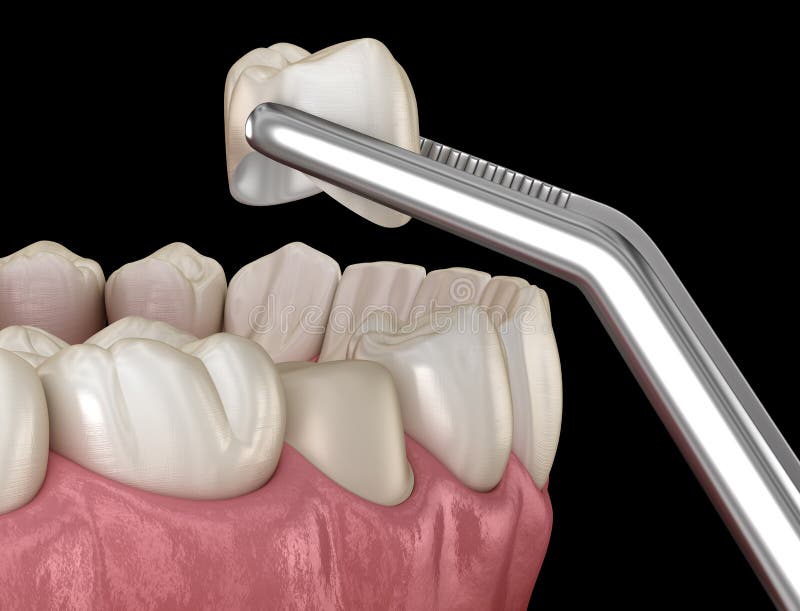 Premolar Preparation Process for Dental Crown Placement. Medically ...