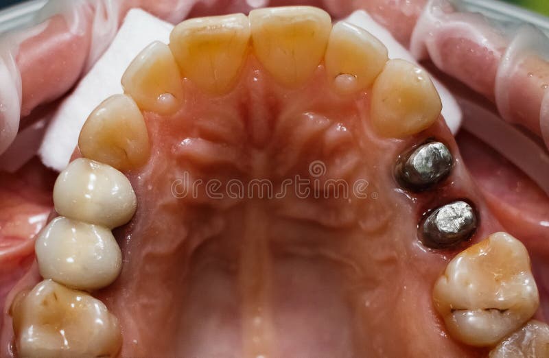 Preparation for Prosthetic Teeth. Teeth Restored with the Help of Metal ...