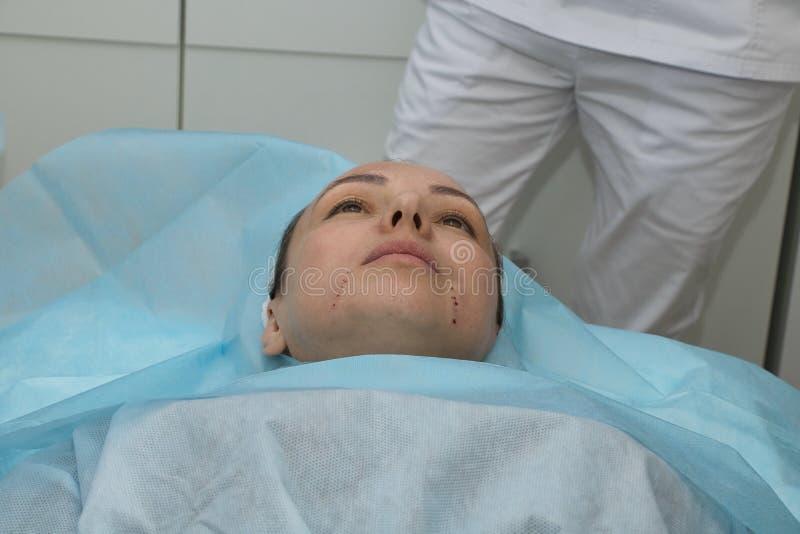 Preparing the Patient for the Cosmetic Thread Lifting Procedure. Stock ...