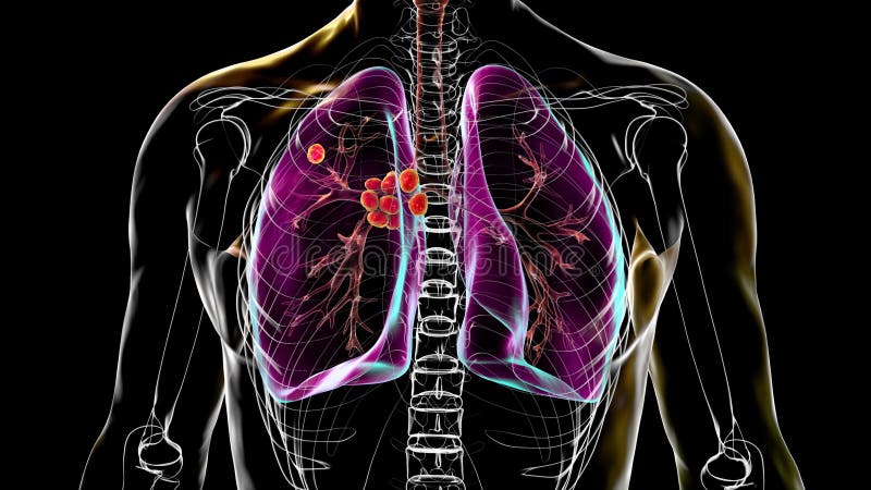 Primary Lung Tuberculosis in a Man with the Ghon Complex, 3D Animation ...