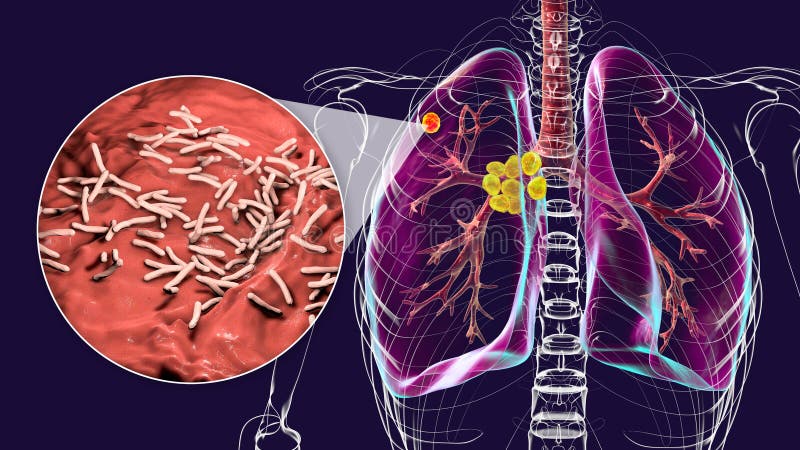 Primary Lung Tuberculosis, 3D Illustration Stock Illustration ...
