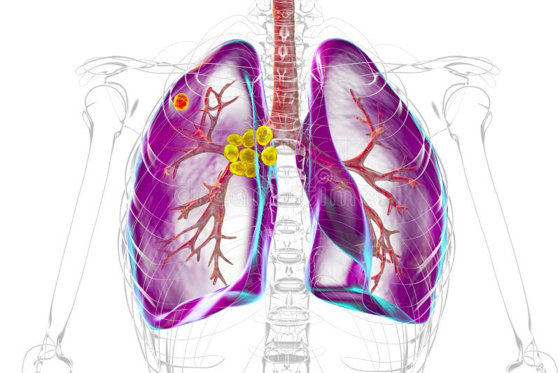 Primary Lung Tuberculosis, 3D Illustration Stock Illustration ...