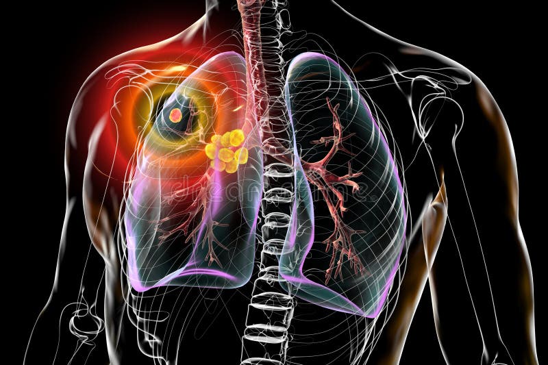 Primary Lung Tuberculosis, 3D Illustration Stock Illustration ...