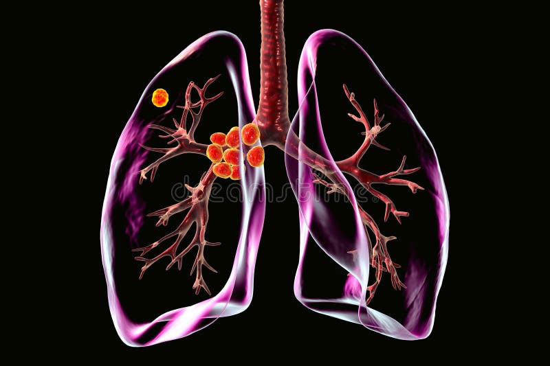 Primary Lung Tuberculosis, 3D Illustration Stock Illustration ...