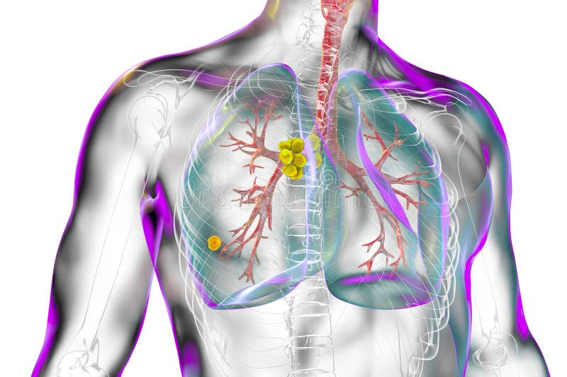 Primary Lung Tuberculosis, 3D Illustration Stock Illustration ...