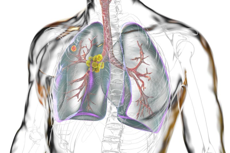 Primary Lung Tuberculosis, 3D Illustration Stock Illustration ...