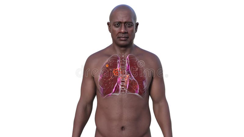 Primary Lung Tuberculosis in a Man with the Ghon Complex, 3D Animation ...