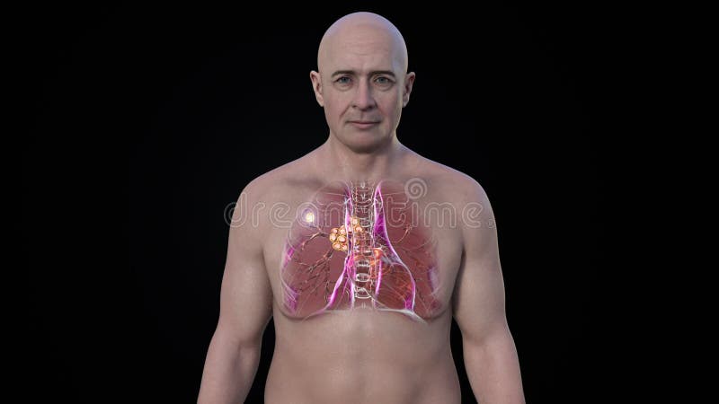 Primary Lung Tuberculosis in a Man with the Ghon Complex, 3D Animation ...