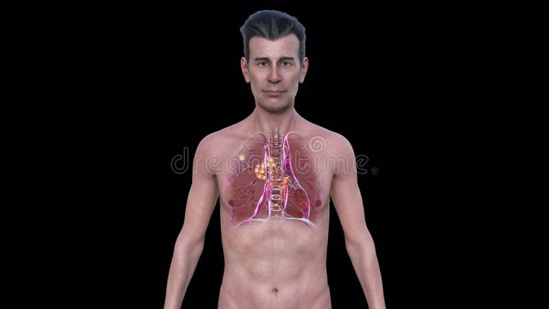 Primary Lung Tuberculosis in a Man with the Ranke Complex, 3D Animation ...