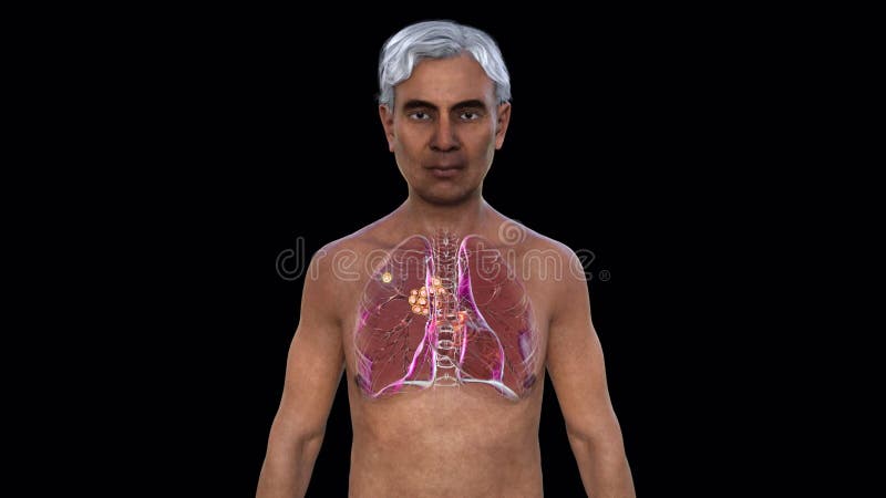 Primary Lung Tuberculosis in a Man with the Ghon Complex, 3D Animation ...