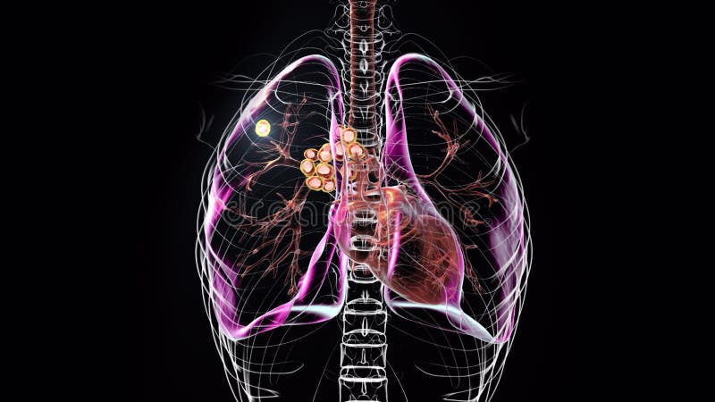 Man with Tuberculosis, 3D Animation Stock Footage - Video of scientific ...