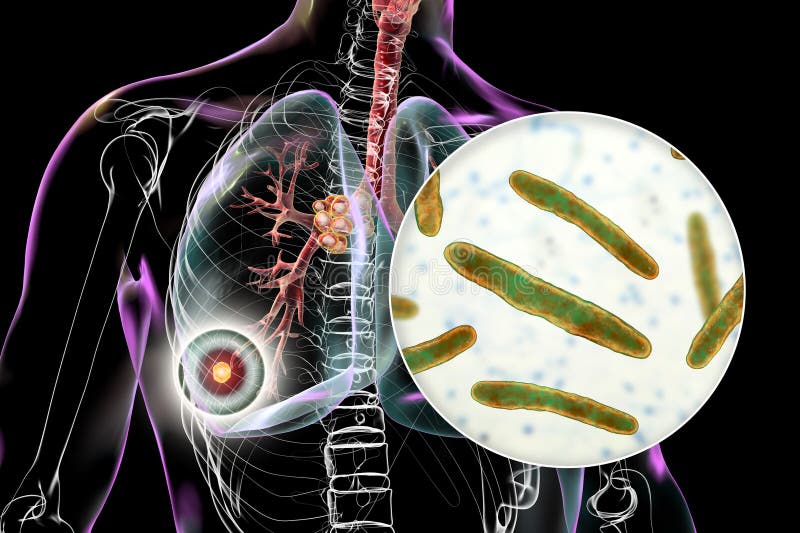 Primary Lung Tuberculosis with the Ranke Complex, 3D Illustration Stock ...