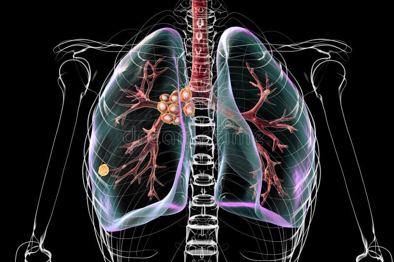 Primary Lung Tuberculosis with the Ranke Complex, 3D Illustration Stock ...