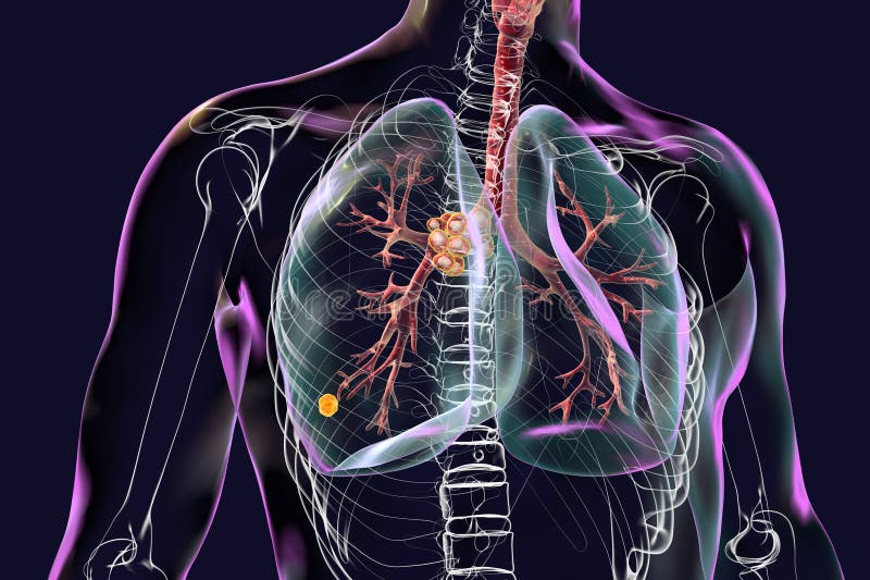 Primary Lung Tuberculosis with the Ranke Complex, 3D Illustration Stock ...