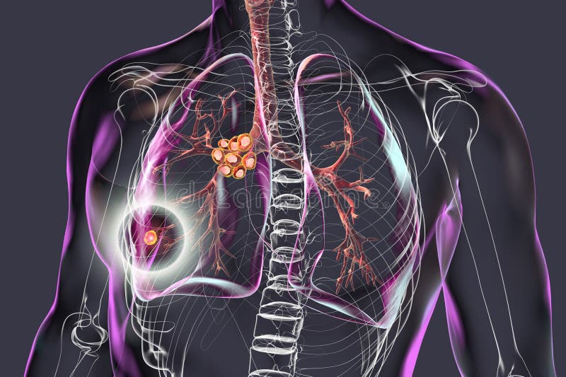 Primary Lung Tuberculosis with the Ranke Complex, 3D Illustration Stock ...
