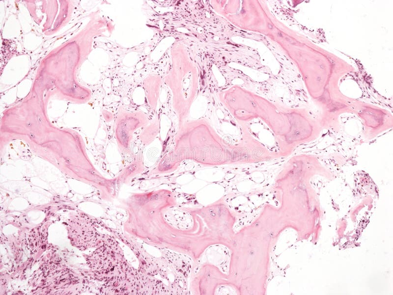 Primary Myelofibrosis (PMF) Cells in Blood Flow - Closeup View 3d ... Primary Myelofibrosis (PMF) Cells in Blood Flow - Closeup View 3d ...