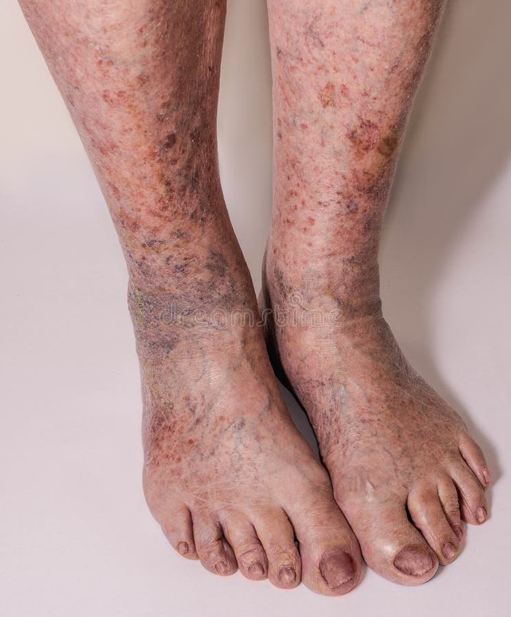 Varices En Piernas Mayores Femeninas La Estructura De Varices Normales ...