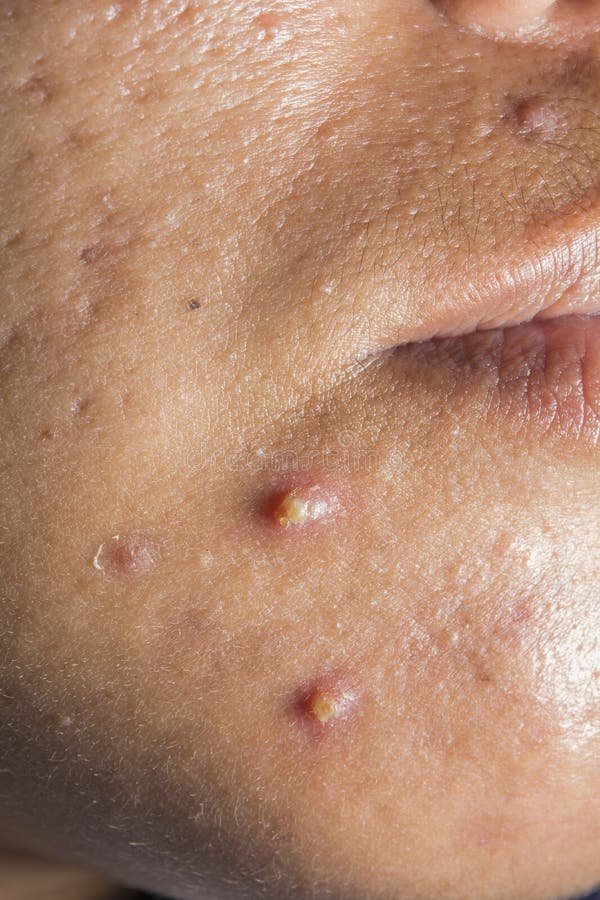 Acne Sul Mento: La Demodecosi Si Spinge Sulla Pelle Del Volto Di Una ...