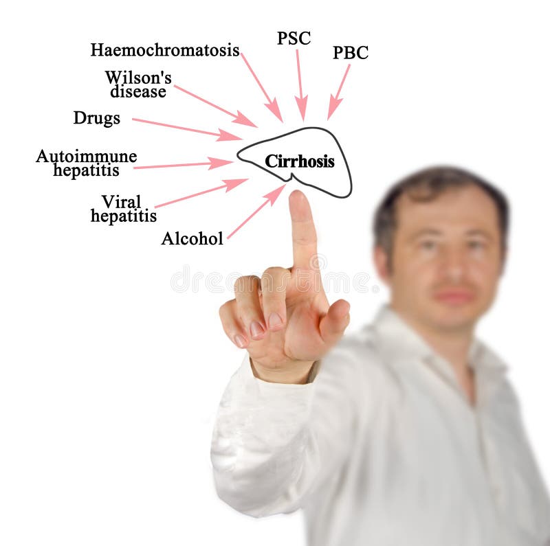 Principais Causas Da Cirrose Foto de Stock - Imagem de doutor, pessoa ...