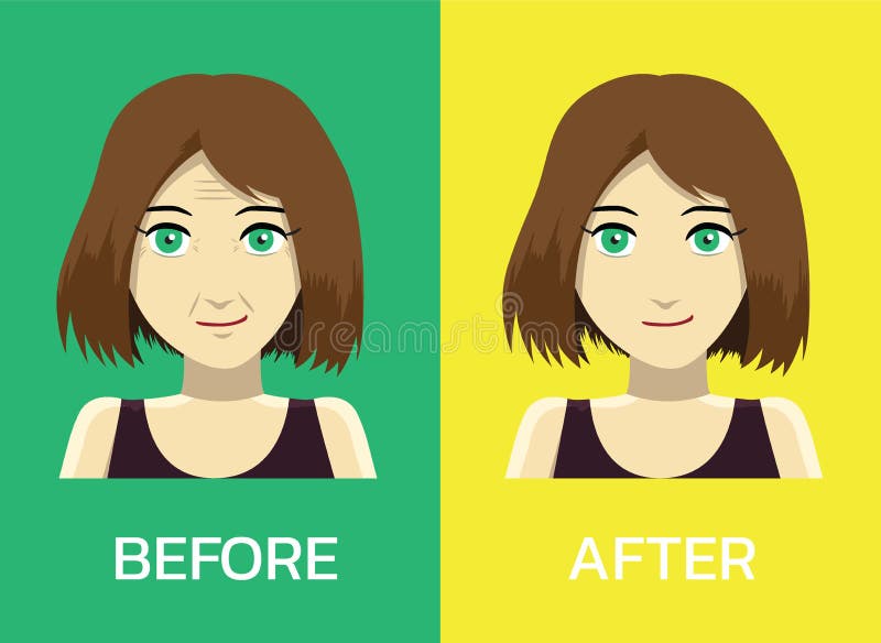 Botox before after Face Manga Woman Cartoon Vector Illustration-01 ...