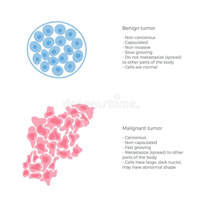 Vector Illustration of Malignant and Benign Tumor Stock Vector ...