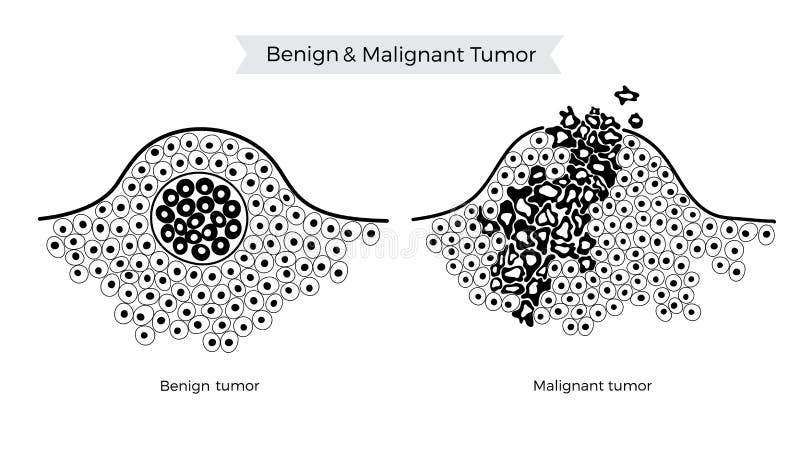 Vector Illustration of Malignant and Benign Tumor Stock Vector ...