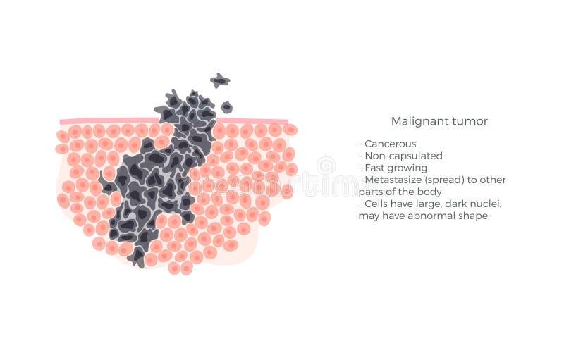 Vector Isolated Illustration of Malignant Tumor Stock Vector ...