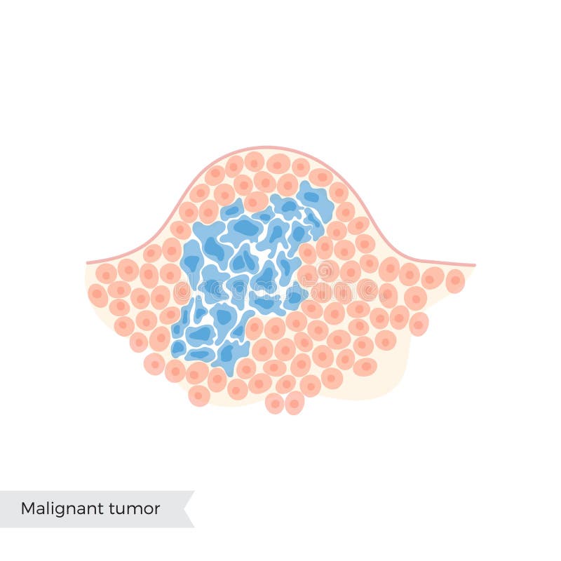 Vector Isolated Illustration of Malignant Tumor Stock Vector ...