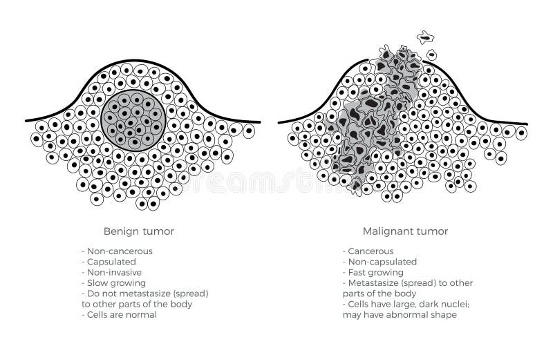 Vector Illustration of Malignant and Benign Tumor Stock Vector ...