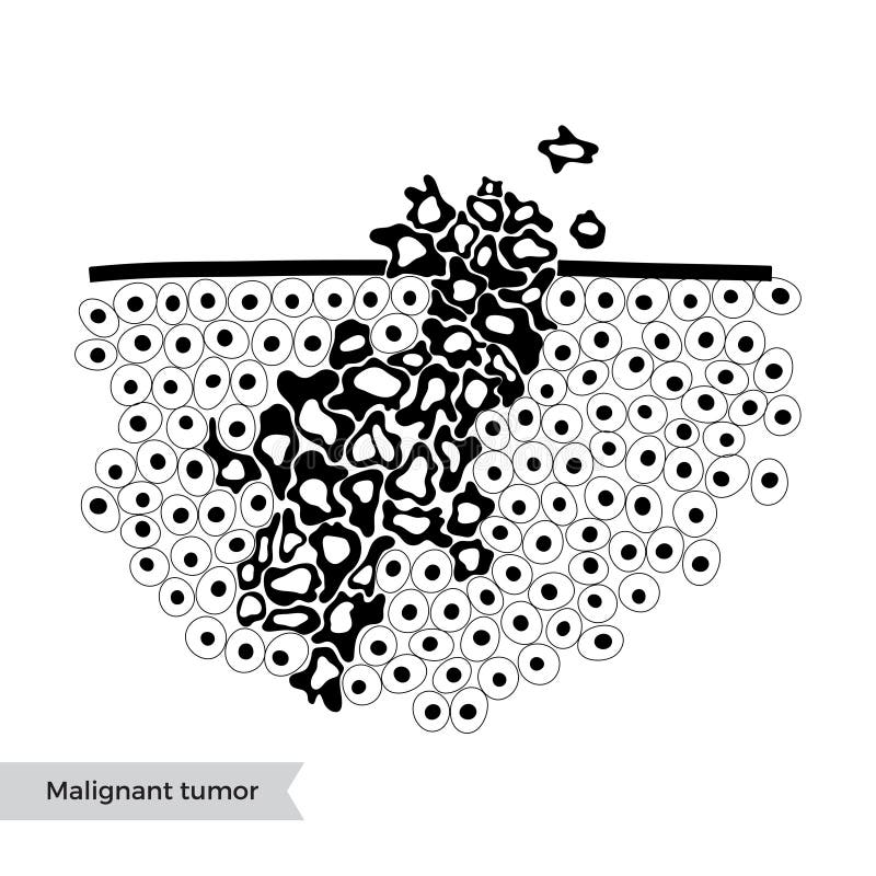 Vector Isolated Illustration of Malignant Tumor Stock Vector ...
