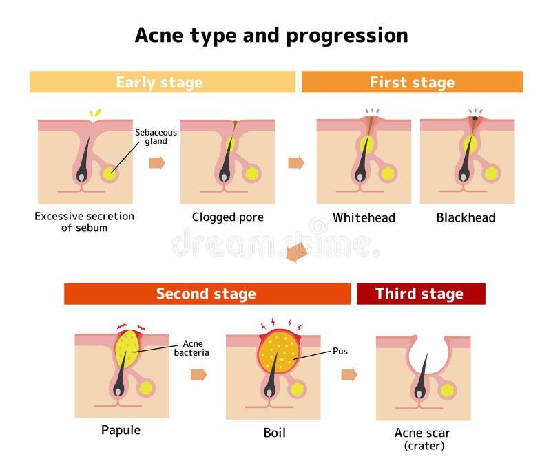 Acne Types and Progression Illustration / English Stock Vector ...