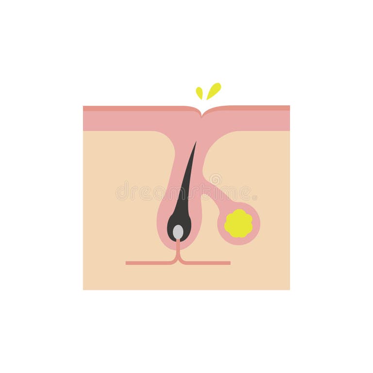 Cross Section of Pores Illustration / Excessive Secretion of Sebum ...