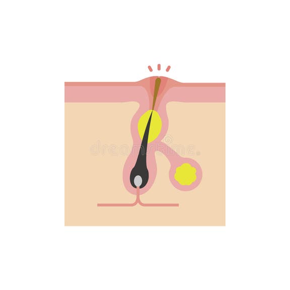 Cross Section of Pores Illustration / Whitehead Stock Vector ...