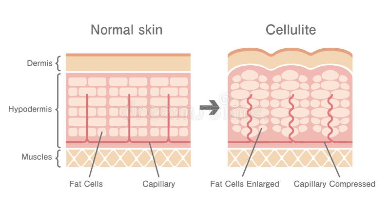 Comparative Illustration of Normal Skin and Cellulite`s Skin Stock ...