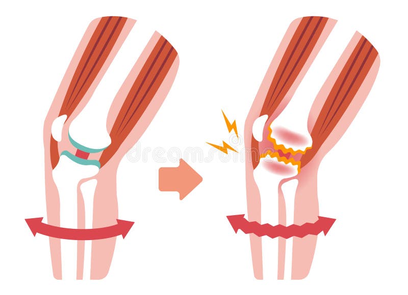 Arthrosis of the knee stock vector. Illustration of fragments - 45824944