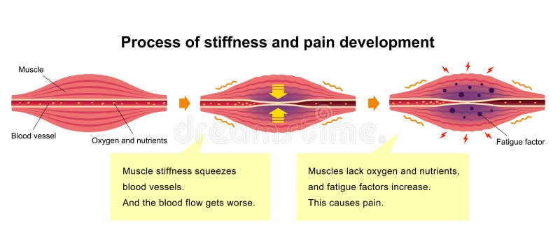 Process of Muscle`s Stiffness and Pain / English Stock Vector ...
