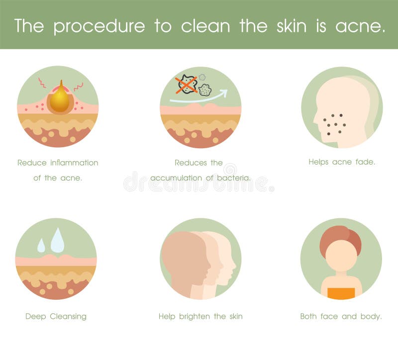 The Procedure To Clean the Skin is Acne. Stock Vector - Illustration of ...