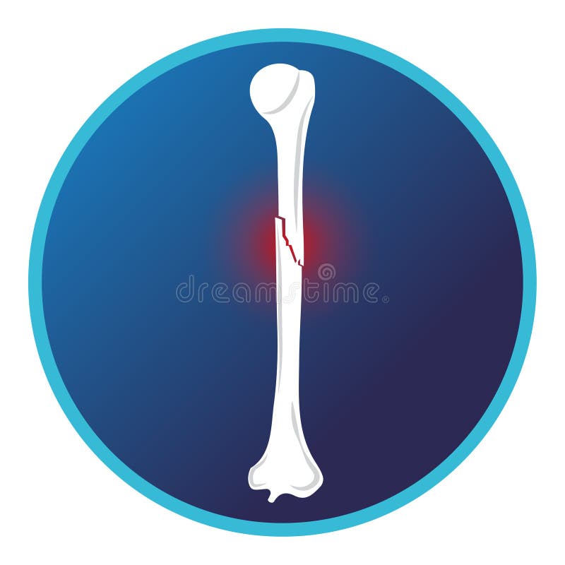 Fracture Shaft of Humerus Bone Icon. Vector Flat Design for Radiology ...