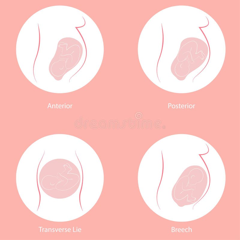 Breech Position Baby Stock Illustrations – 10 Breech Position Baby ...